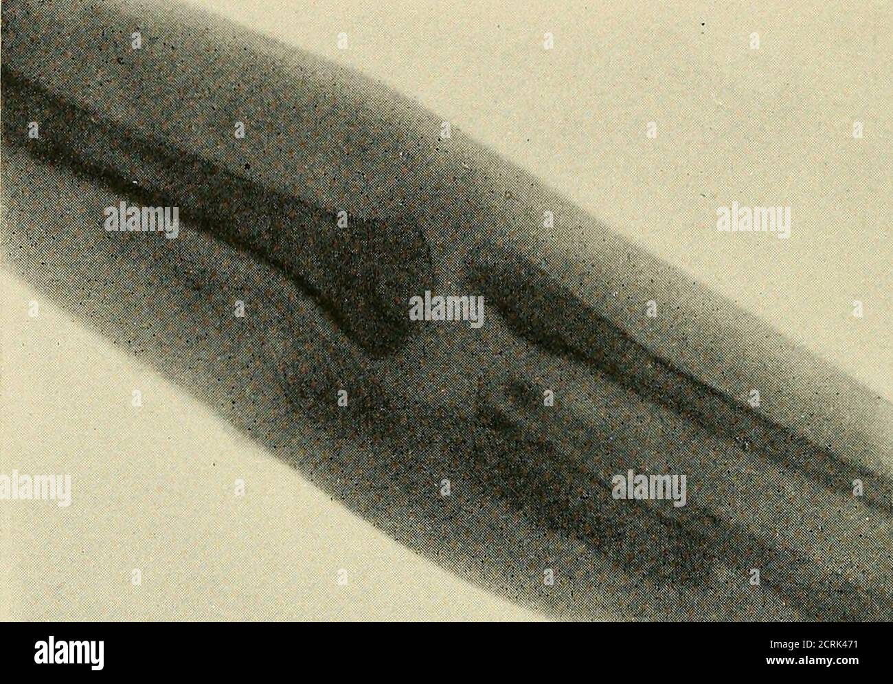 Phlegmon hi-res stock photography and images - Alamy