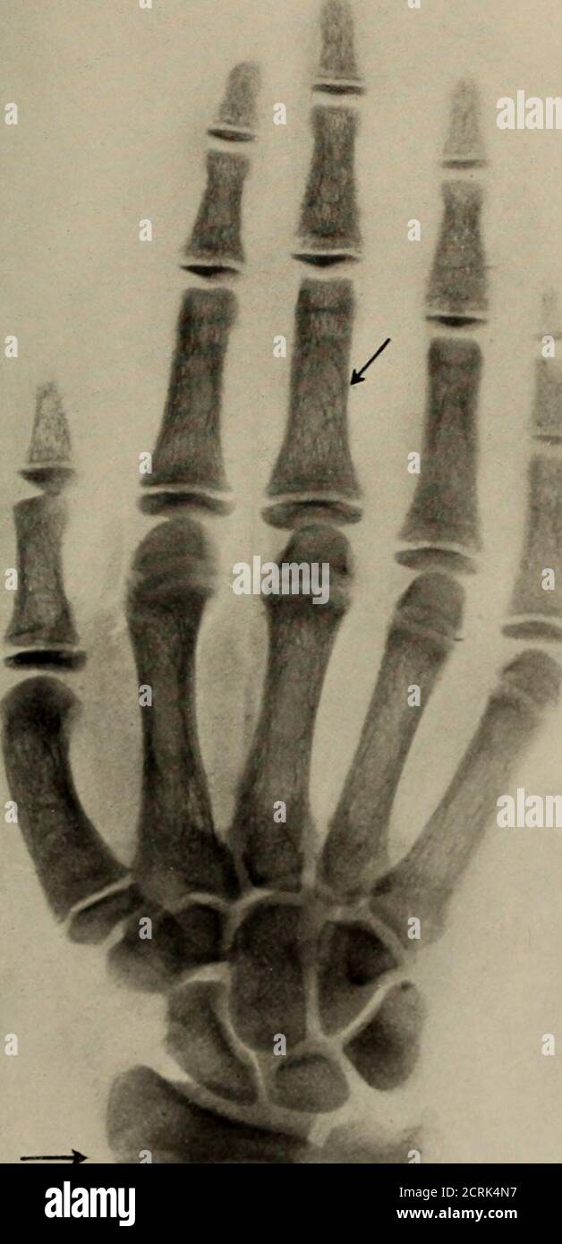 . Living anatomy and pathology; . FIG. 2. I PLATE 88.RHACHITIS OF ...