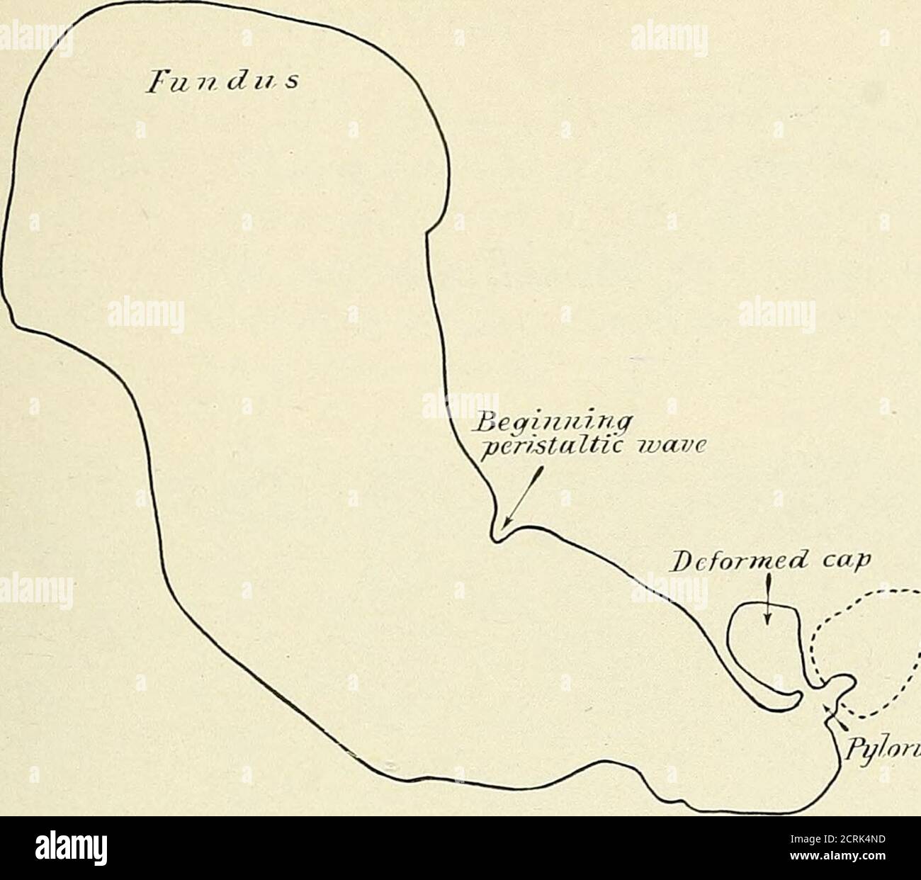 Duodenal cap hi-res stock photography and images - Alamy