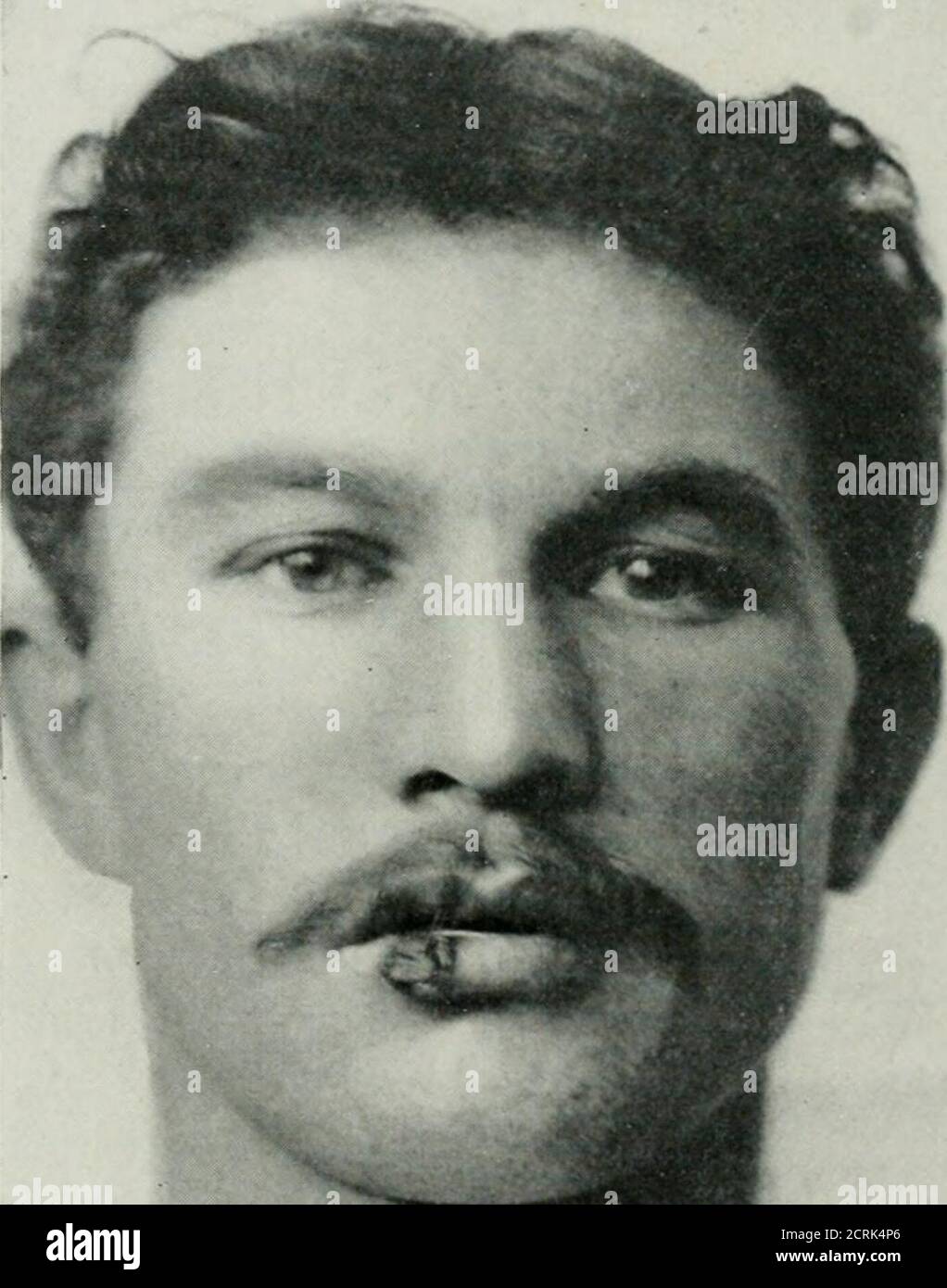 X ray burn hi-res stock photography and images - Alamy