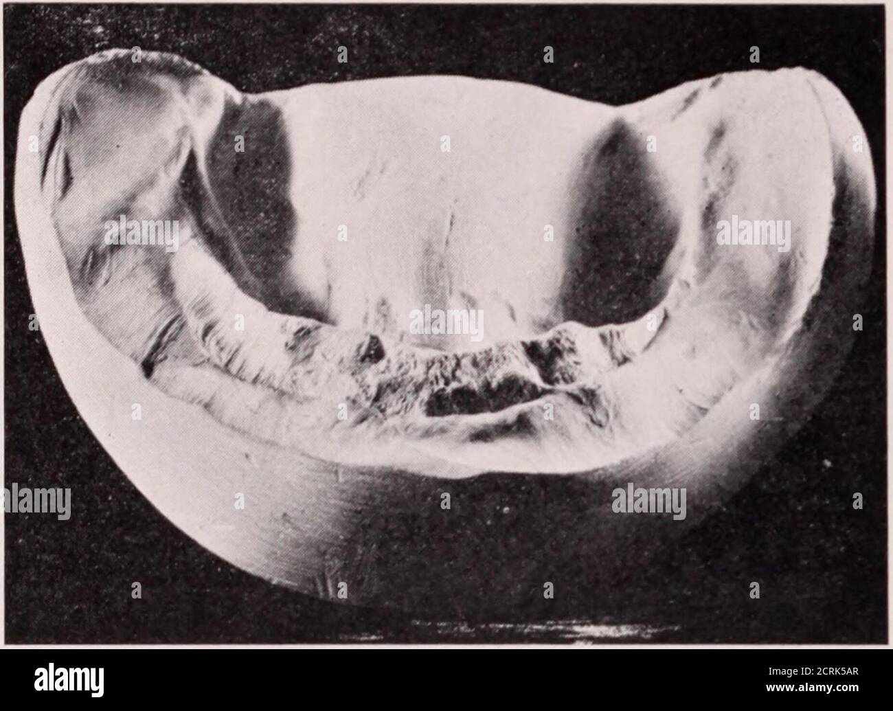 Alveolar collapse hi-res stock photography and images - Alamy