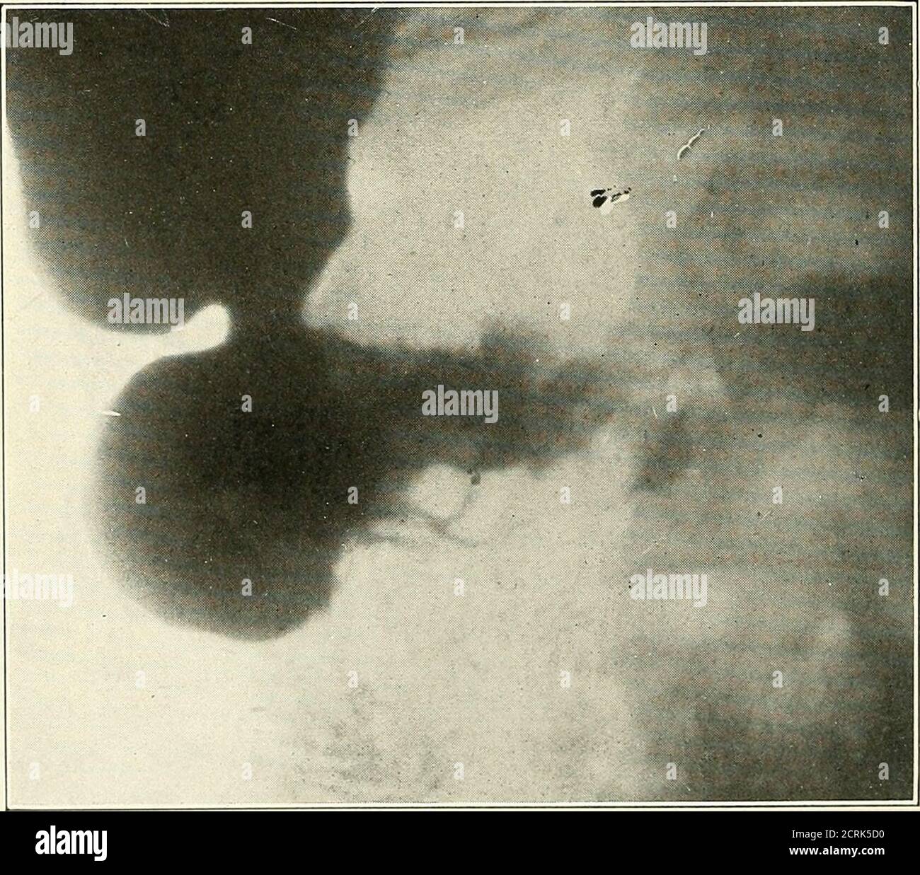 Stasis ulcer hi-res stock photography and images - Alamy