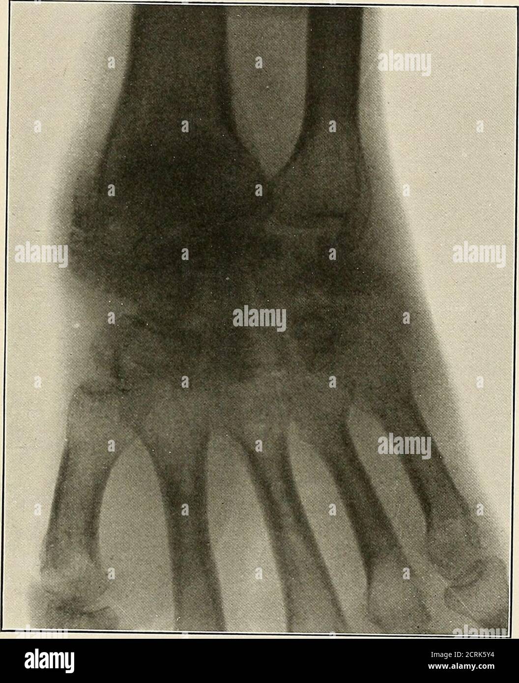 . A radiographic atlas of the pathologic changes of bones and joints ...
