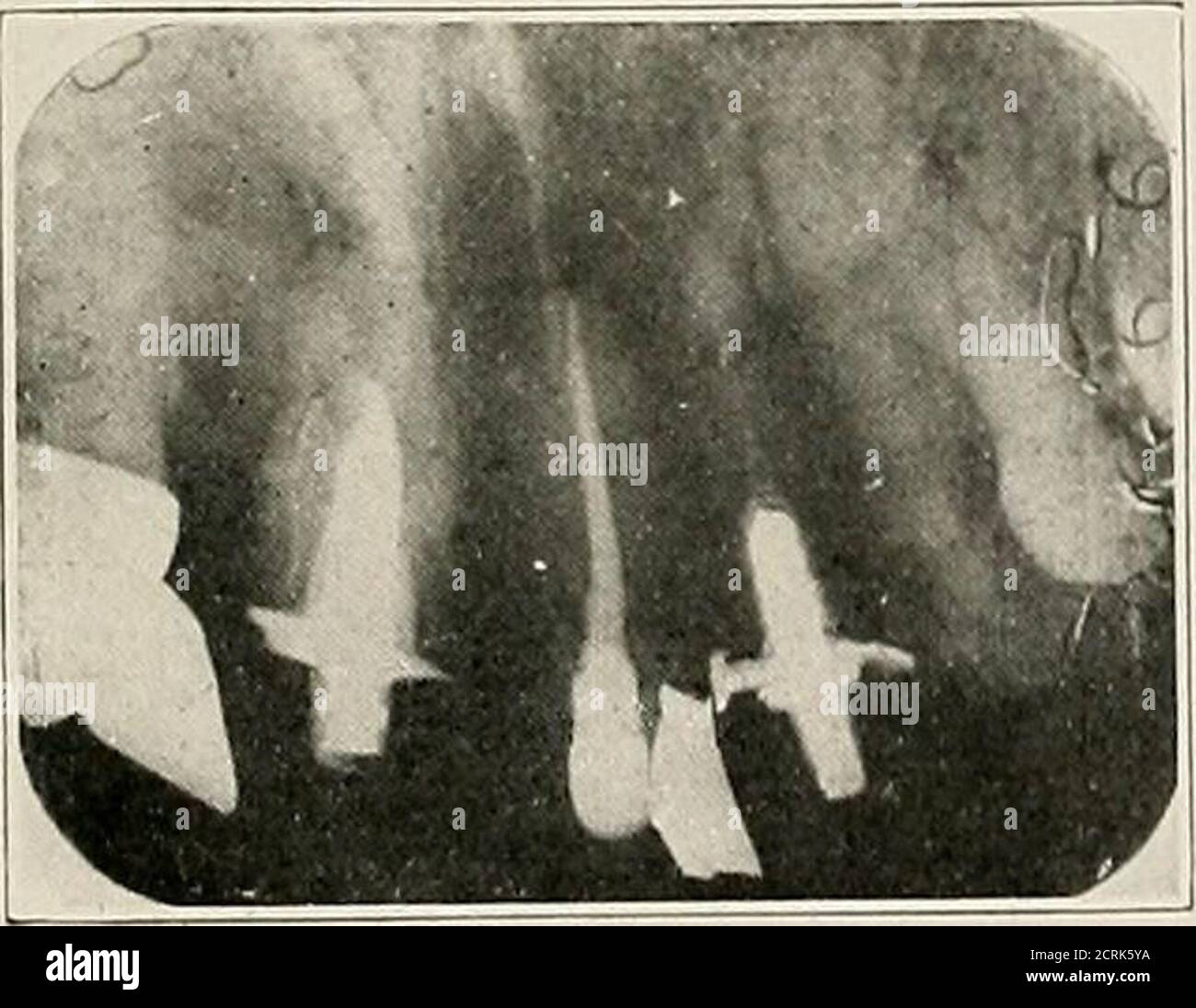 . Interpretation of dental and maxillary roentgenograms . Fig. 54. Fig ...