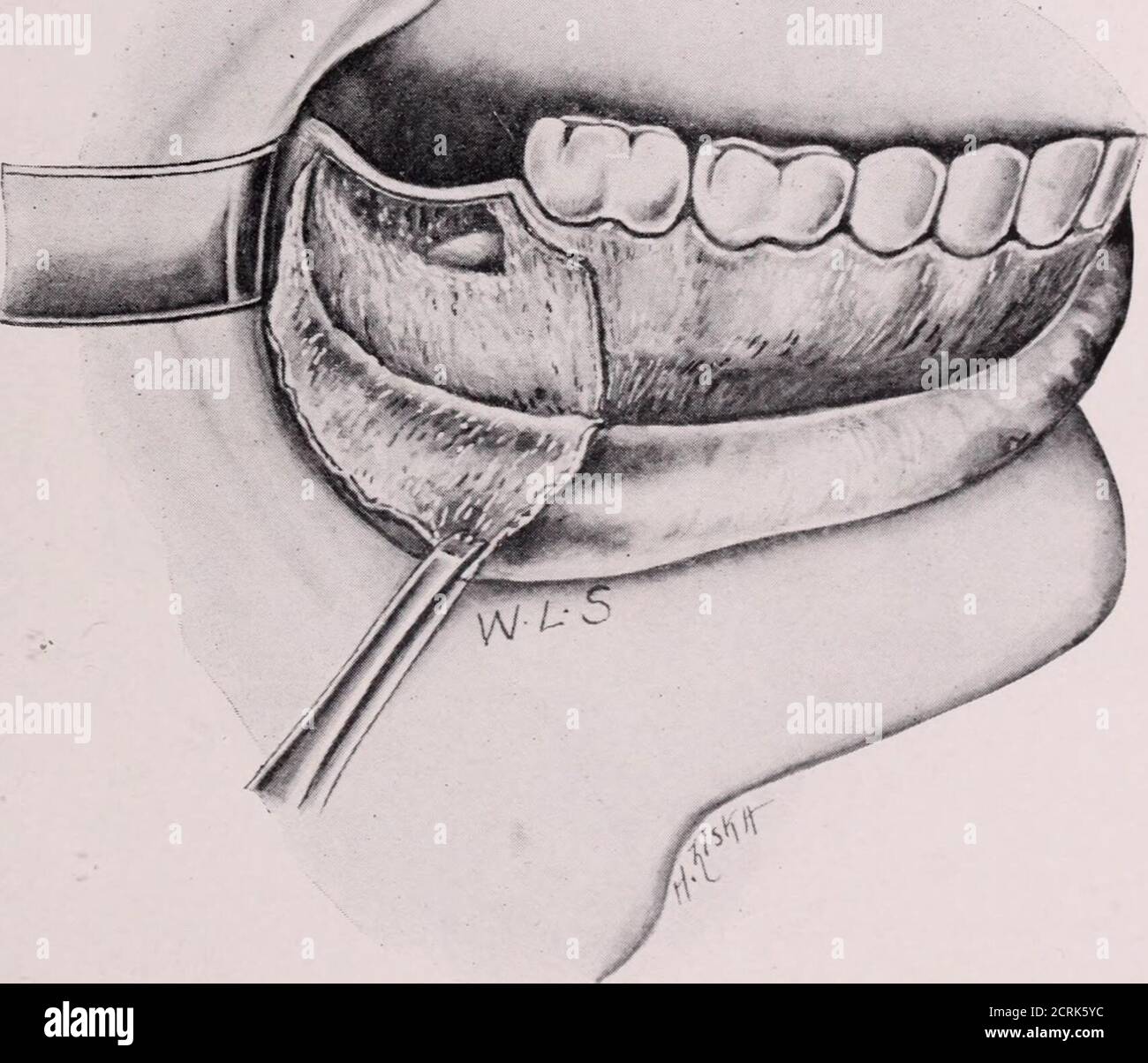 . Journal of radiology . Fig. 17—Diagramatic of imbedded tooth. Page ...