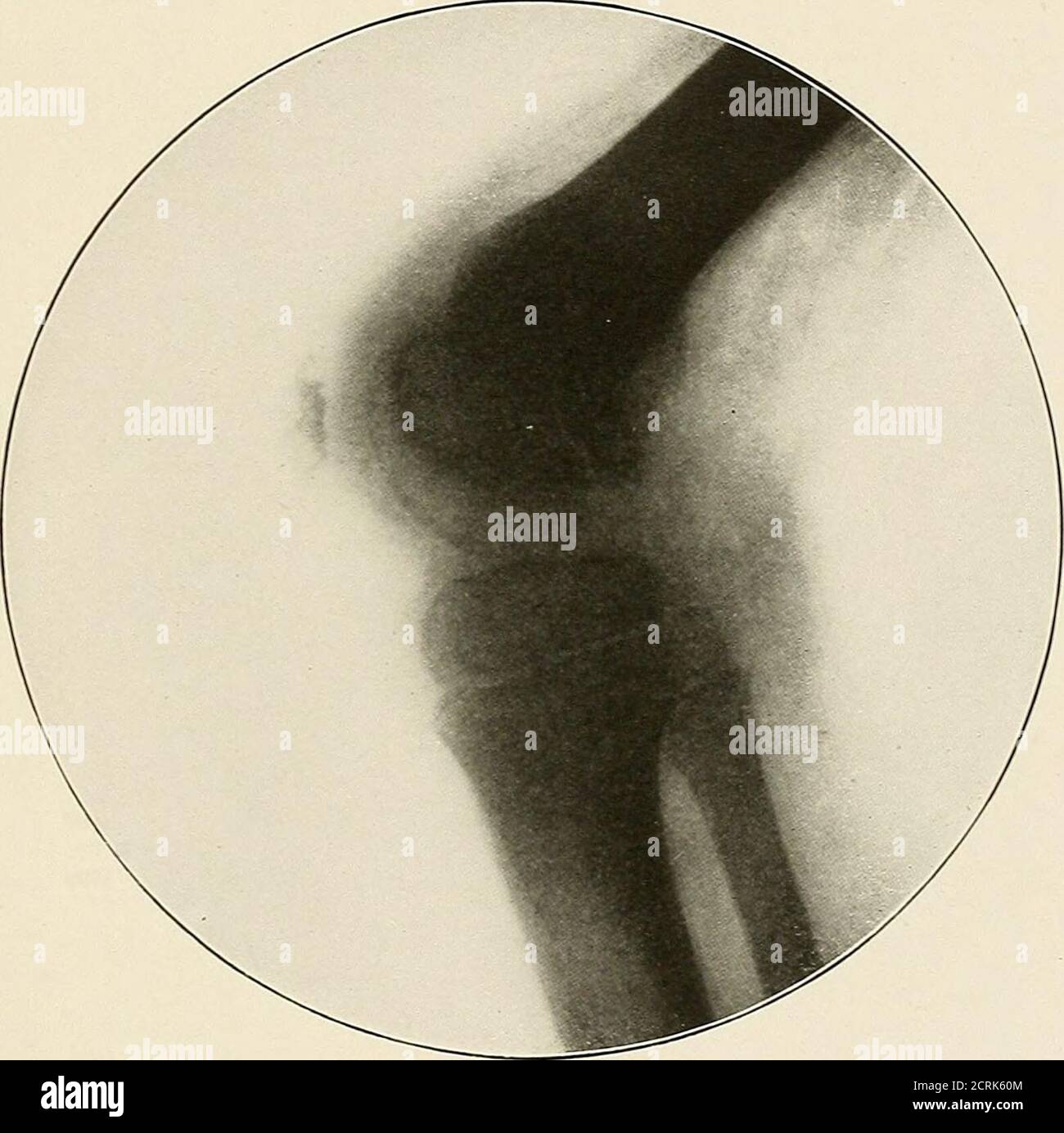 Epiphyseal growth plate hi-res stock photography and images - Alamy