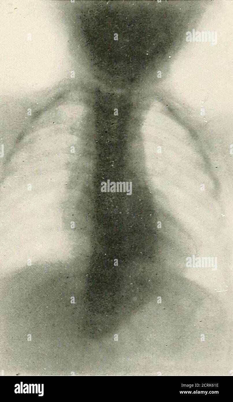 Pulmonary rales hi-res stock photography and images - Alamy