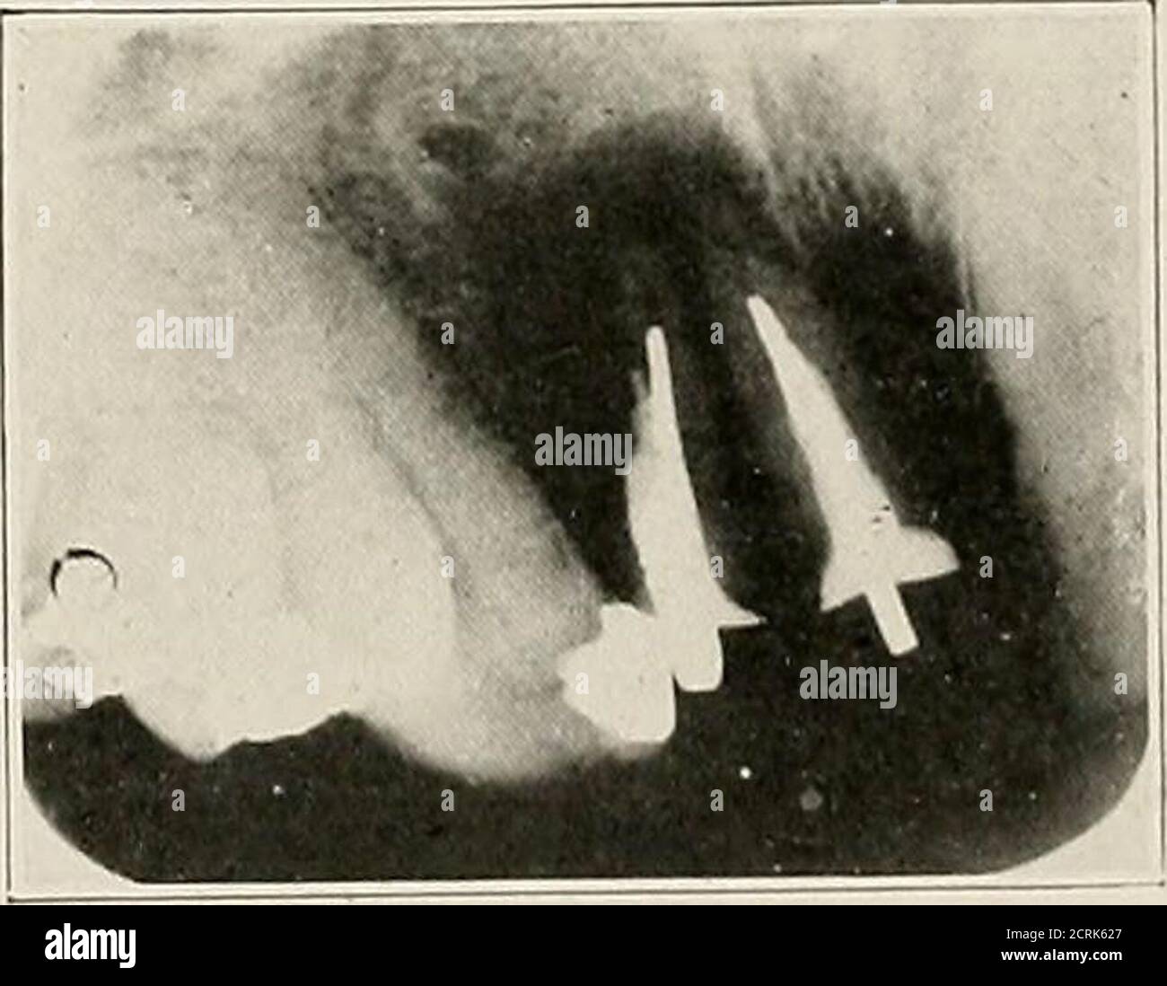 . Interpretation of dental and maxillary roentgenograms . Fis. 56. Fig ...