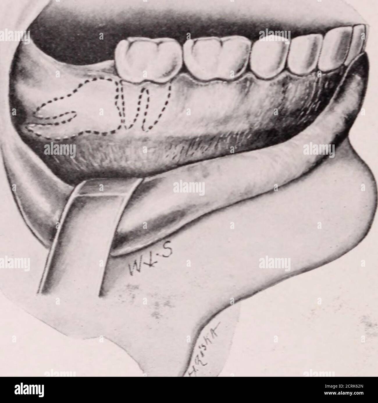 . Journal of radiology . Page Fifteen PATHOLOGY OF MOUTH—SHEARER Figs ...