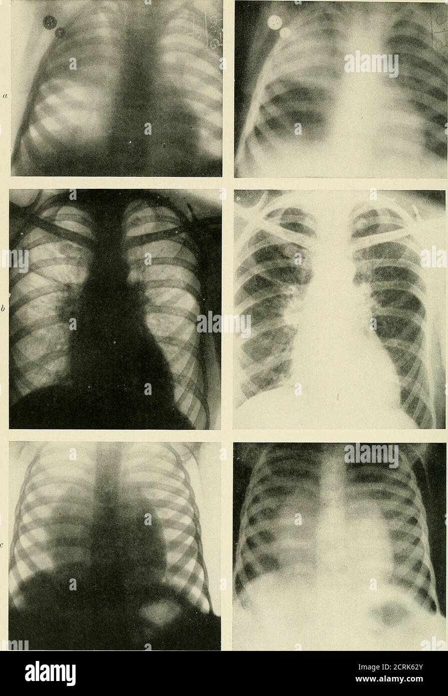 Peribronchial Cuffing