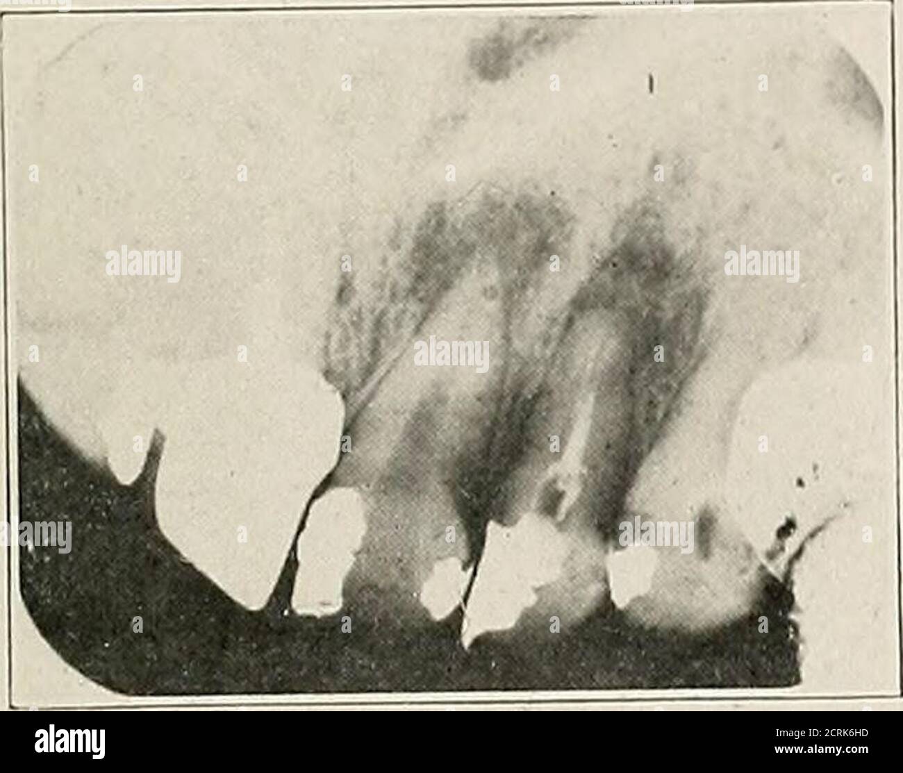 . Interpretation of dental and maxillary roentgenograms . Fig. 52. Fig ...