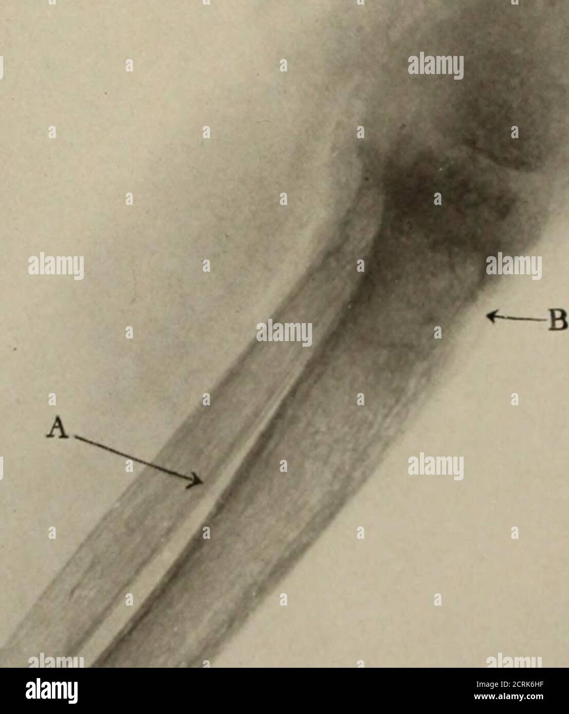. Living anatomy and pathology; . PLATE S3.RHACHITIS. (Same subject as ...