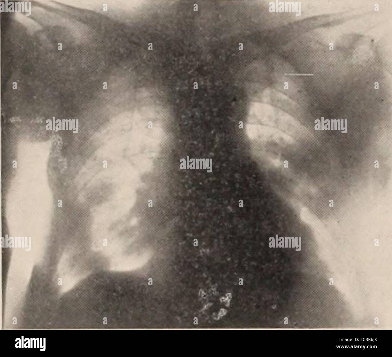 Dermoid cyst hi-res stock photography and images - Alamy