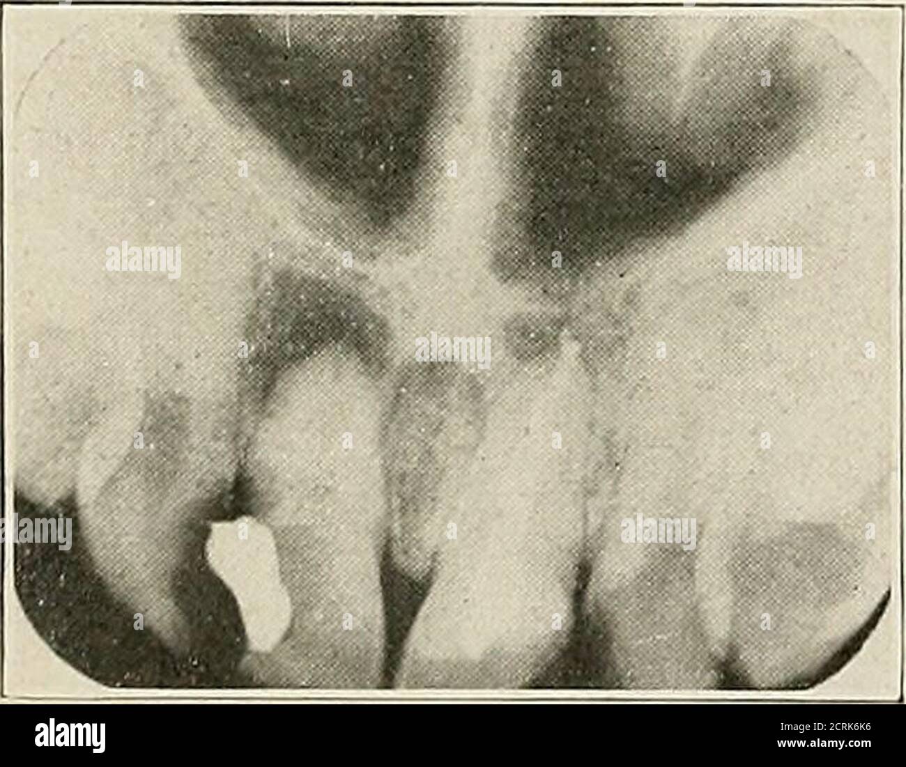 . Interpretation of dental and maxillary roentgenograms . Fig. 50. Fig ...