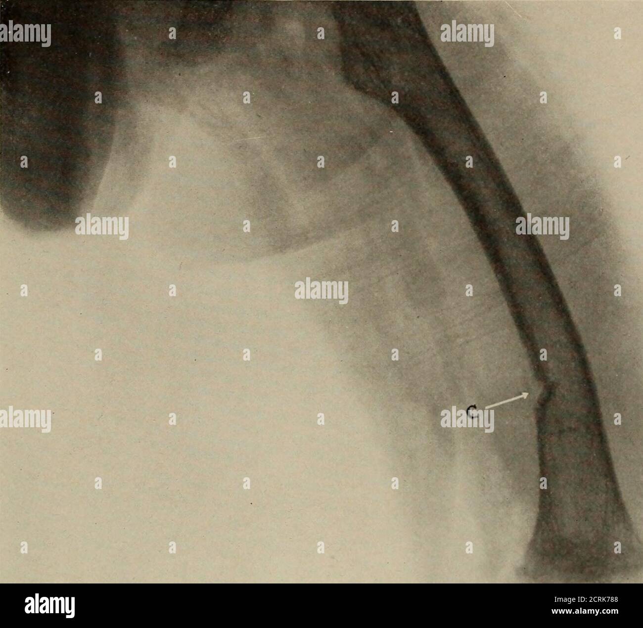 . Living anatomy and pathology; . PLATE 82.EARLY RHACHITIS. Age 2 years ...