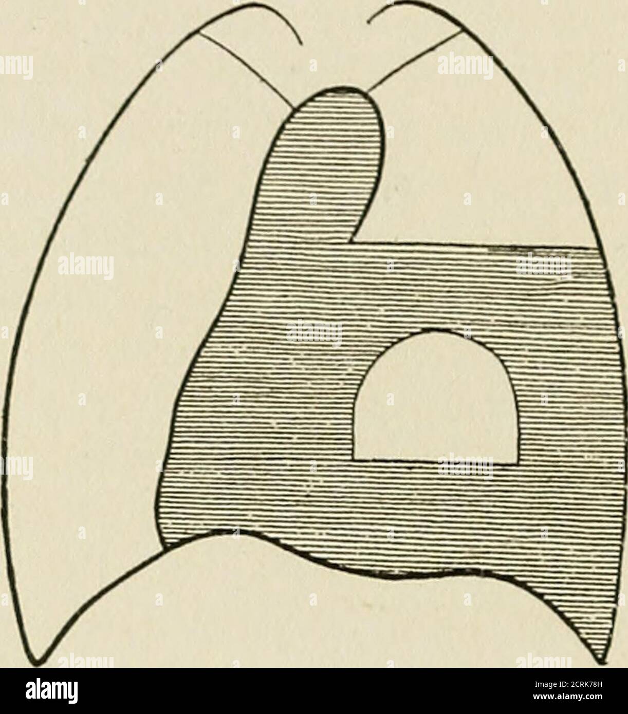. Radio-diagnosis of pleuro-pulmonary affection . had brought about the ...