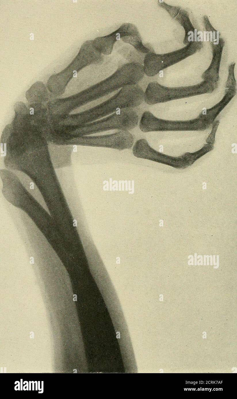 Rontgen Hand High Resolution Stock Photography and Images - Alamy