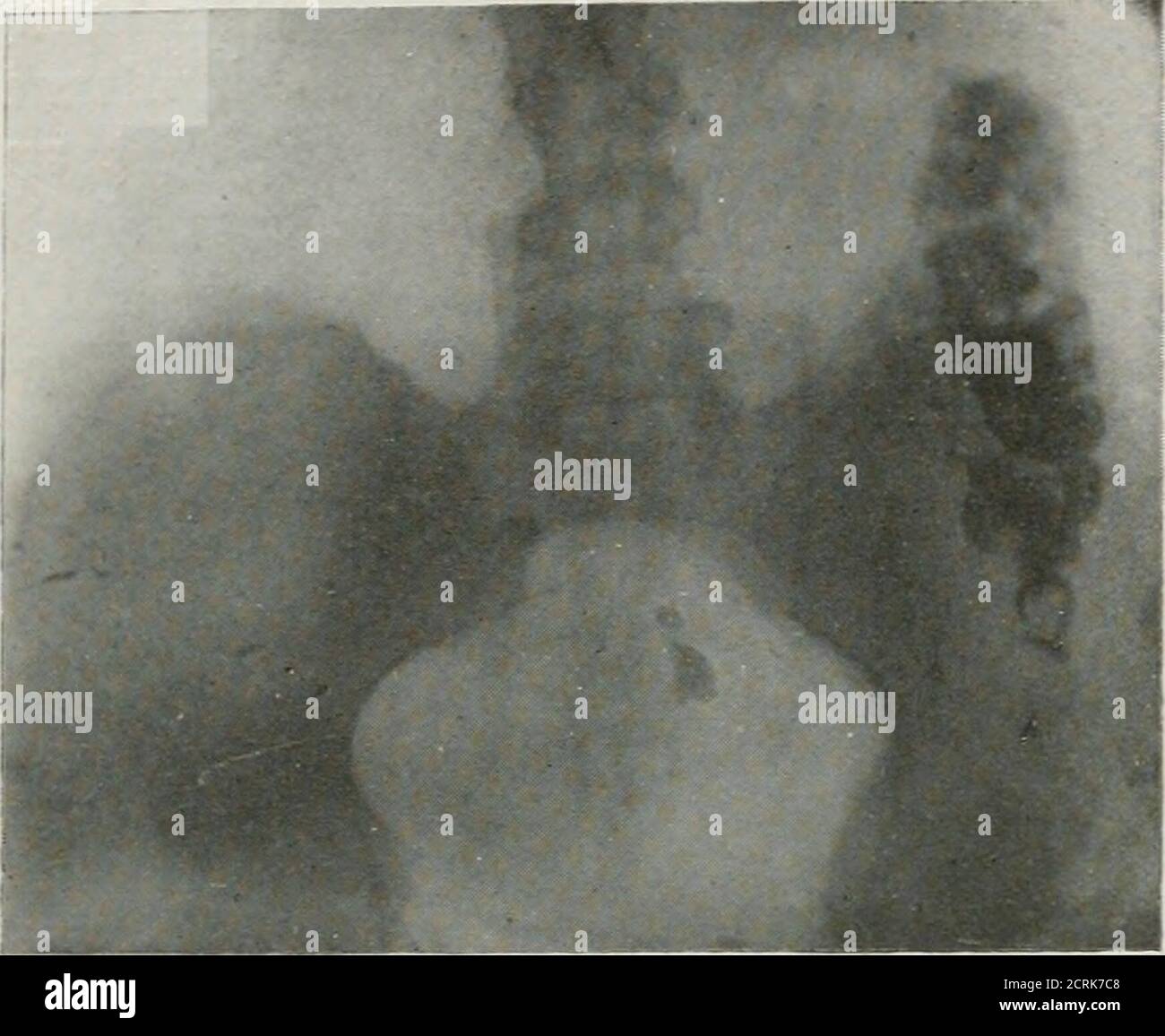 Pylorospasm hi-res stock photography and images - Alamy