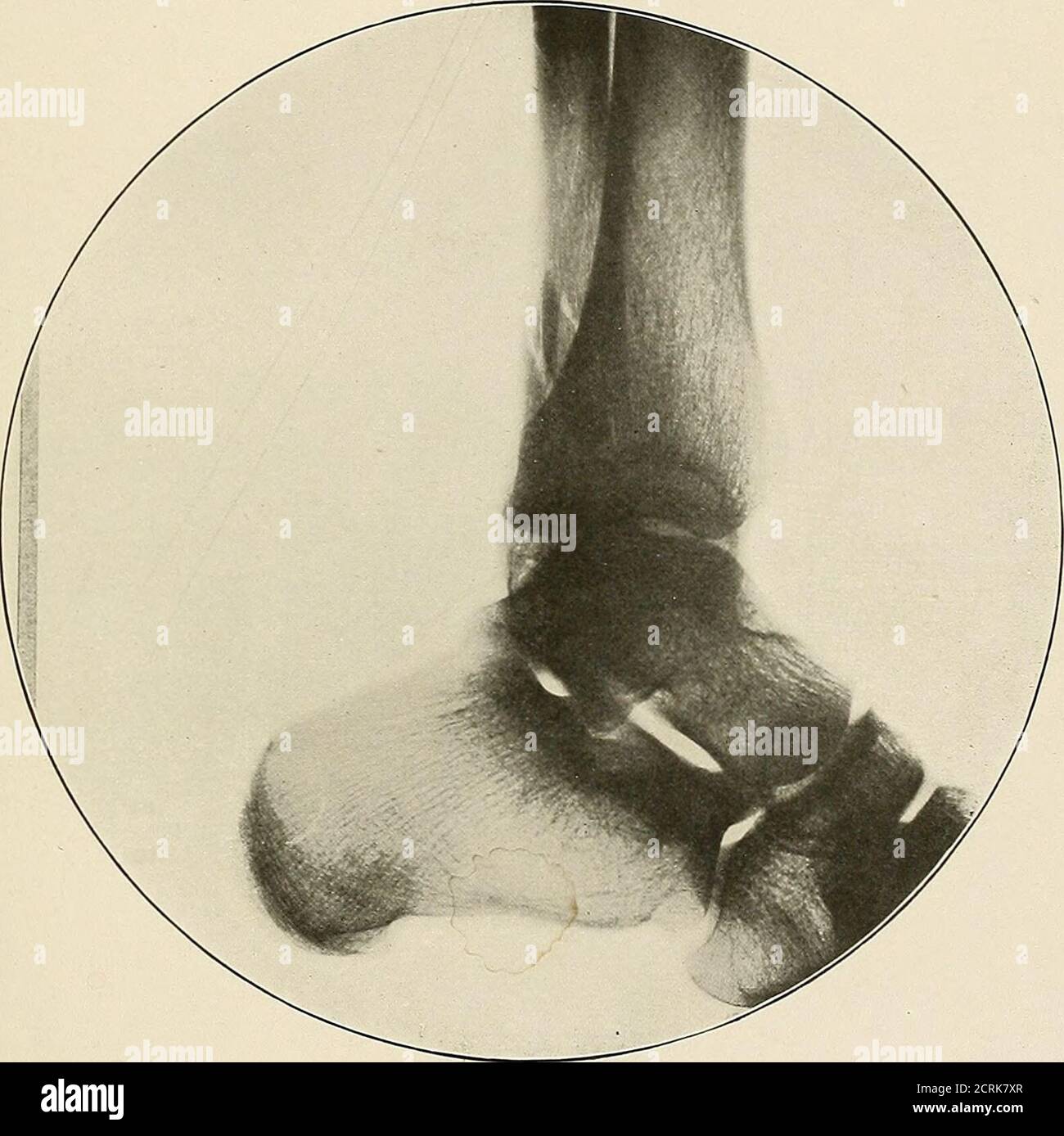 . A radiographic atlas of the pathologic changes of bones and joints ...