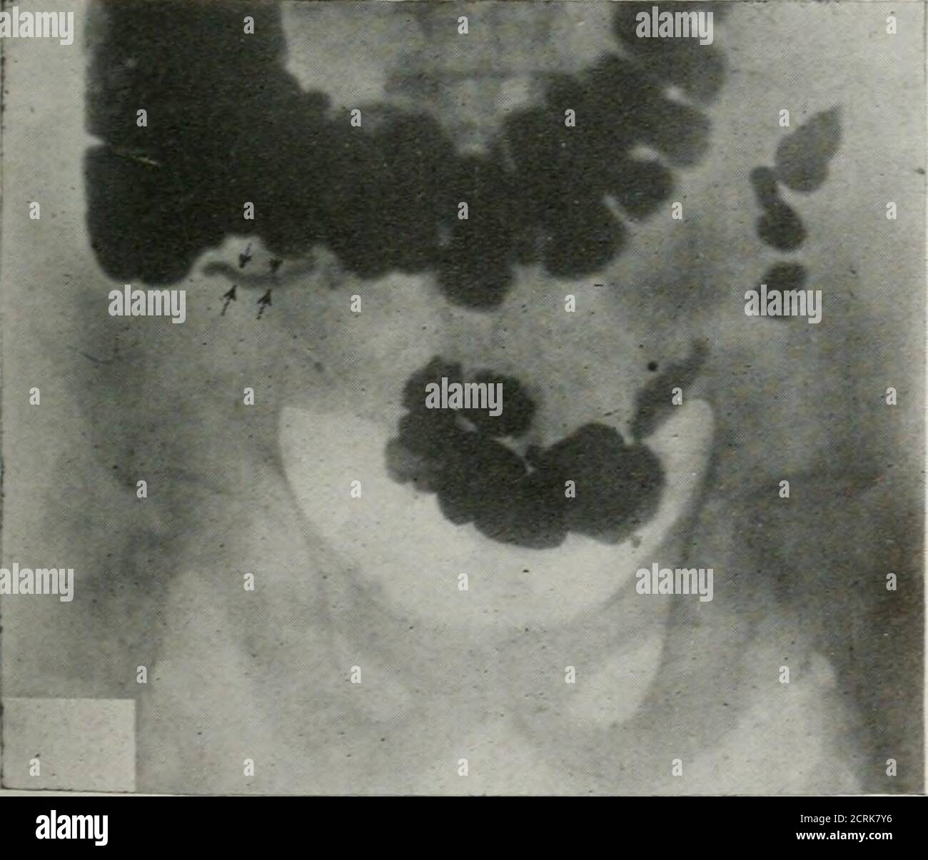 Cecum examination hi-res stock photography and images - Alamy