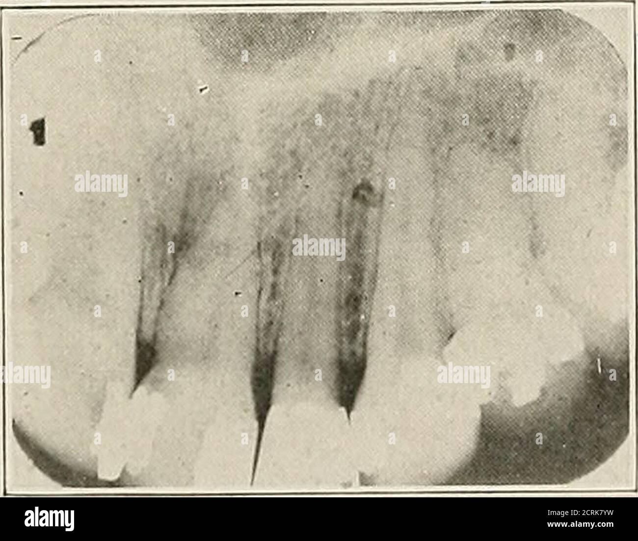 . Interpretation of dental and maxillary roentgenograms . Fig. 42. Fig ...