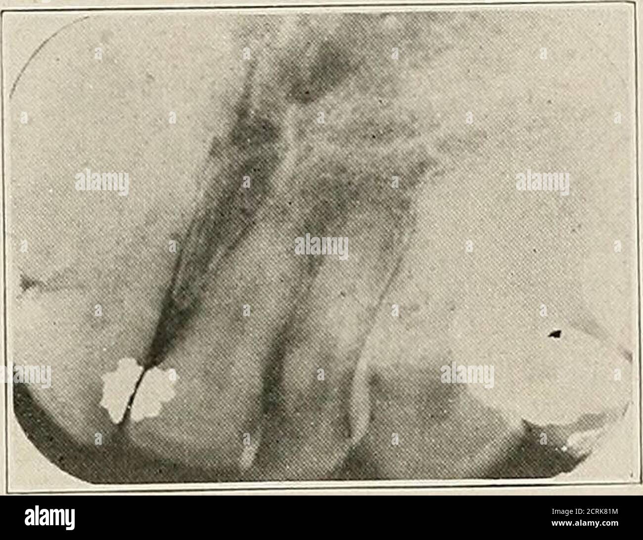 . Interpretation of dental and maxillary roentgenograms . Fig. 41. Fig ...