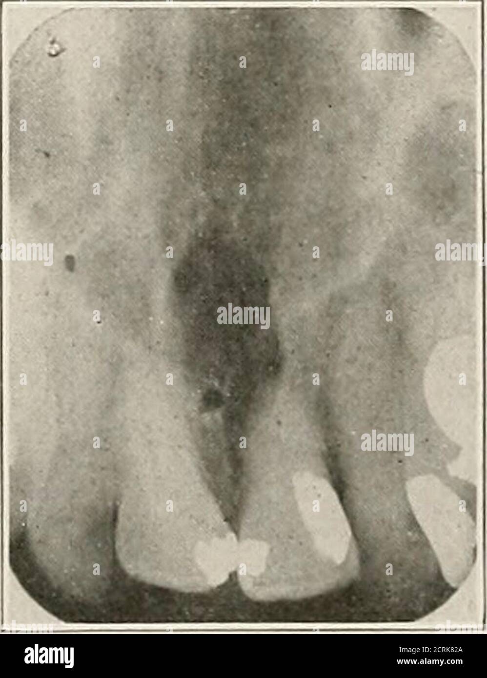 . Interpretation of dental and maxillary roentgenograms . Fig. 40.. Fig ...