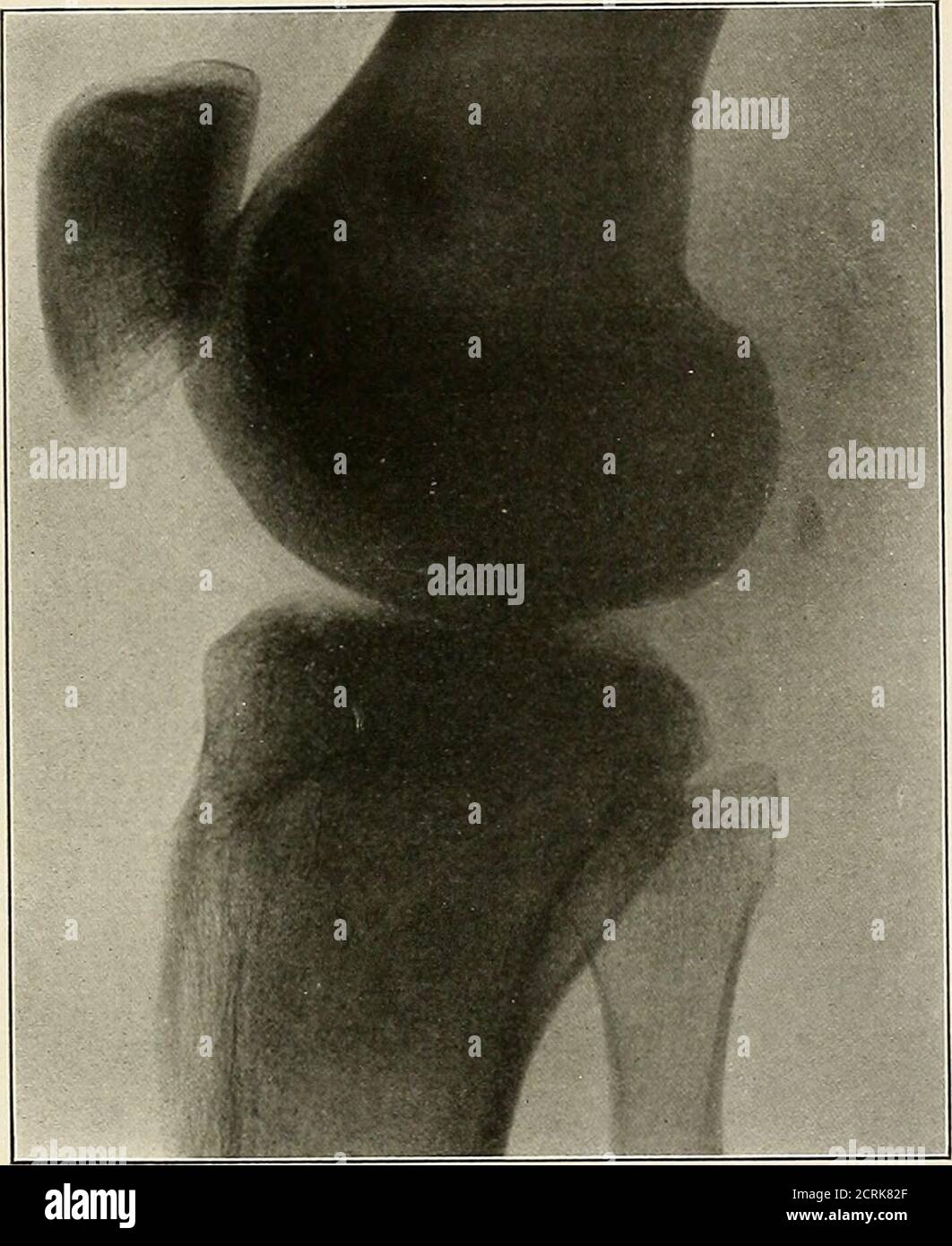 . A radiographic atlas of the pathologic changes of bones and joints ...