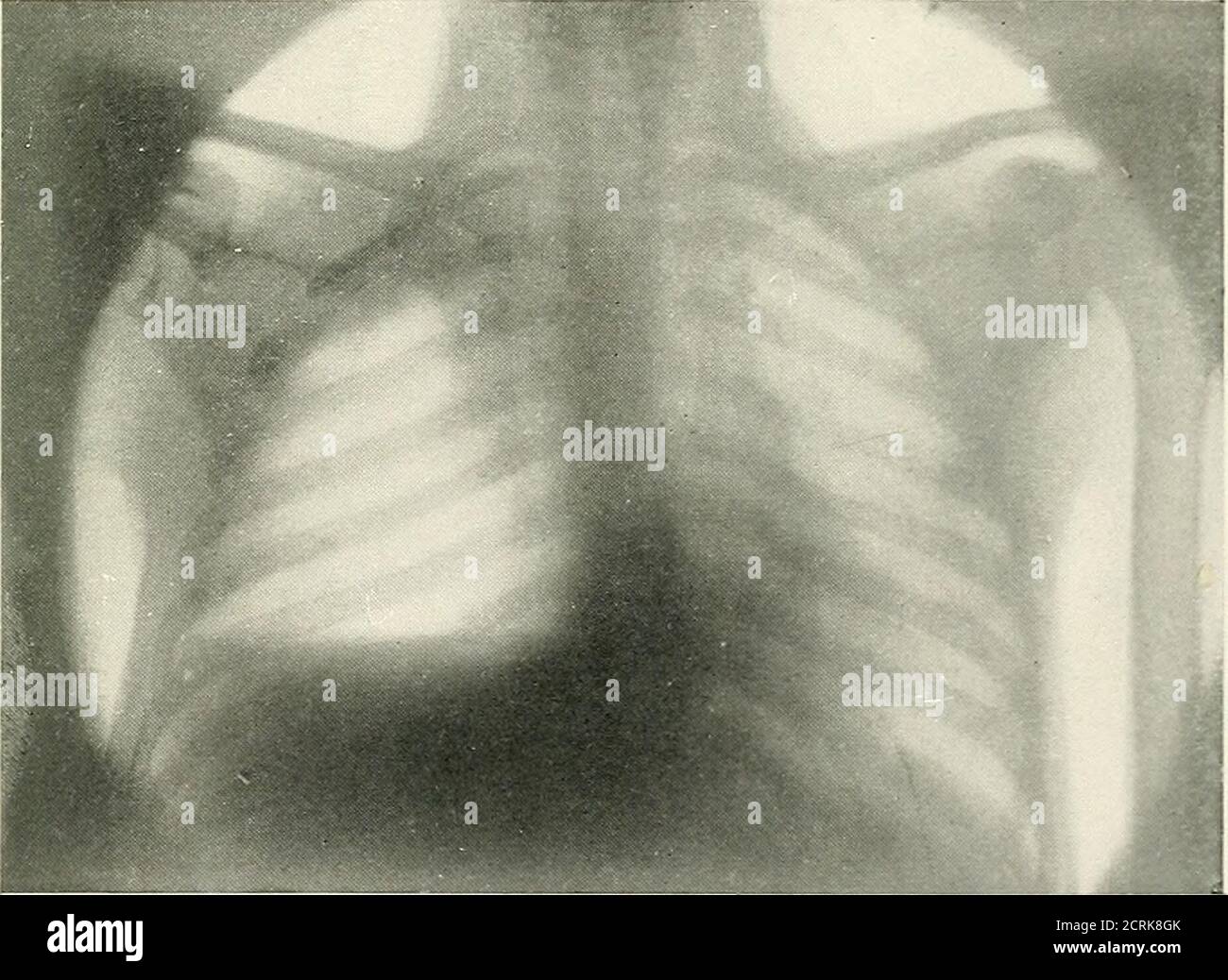 Pyopneumothorax hi-res stock photography and images - Alamy