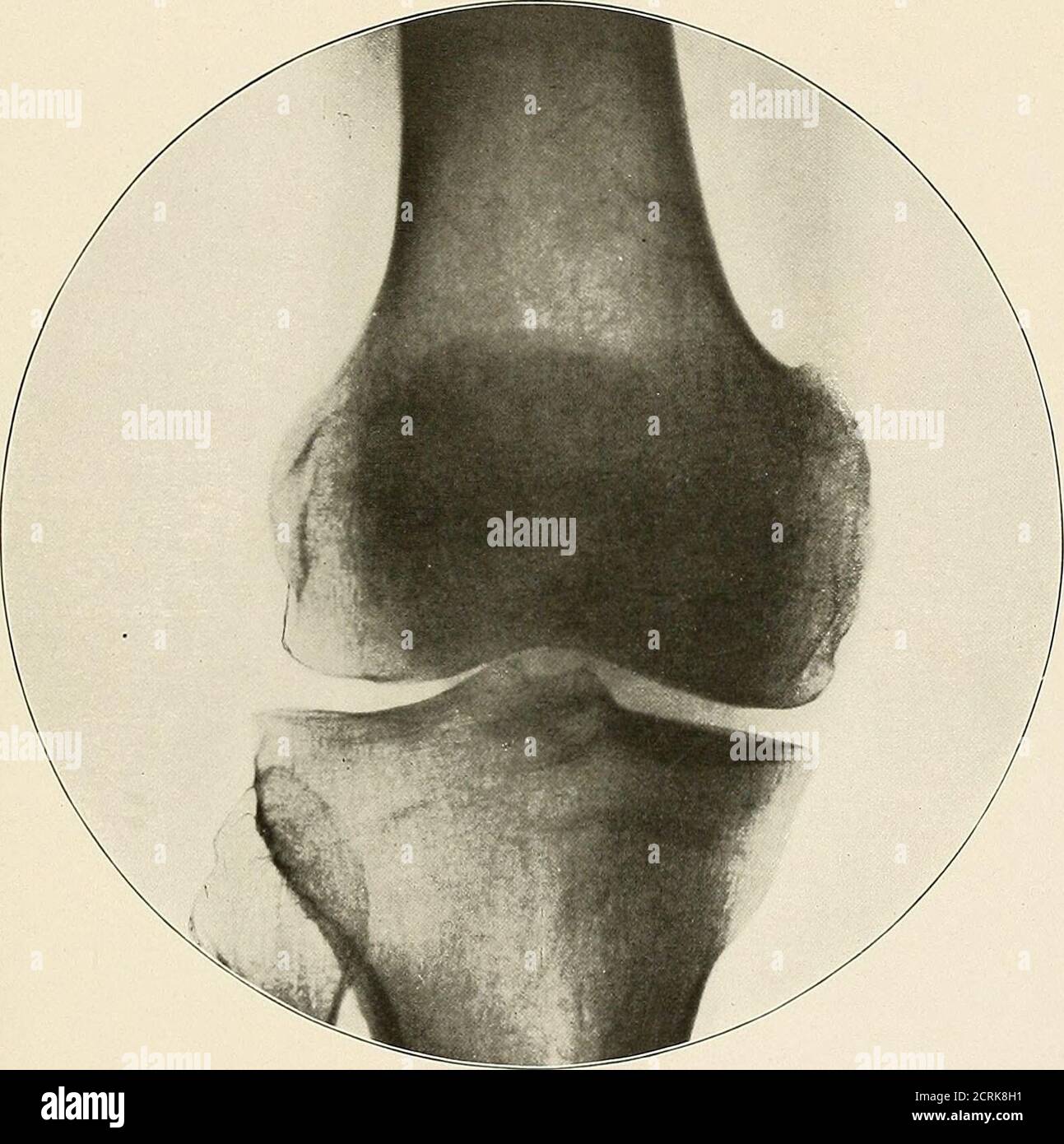 Normal knee x ray hi-res stock photography and images - Alamy