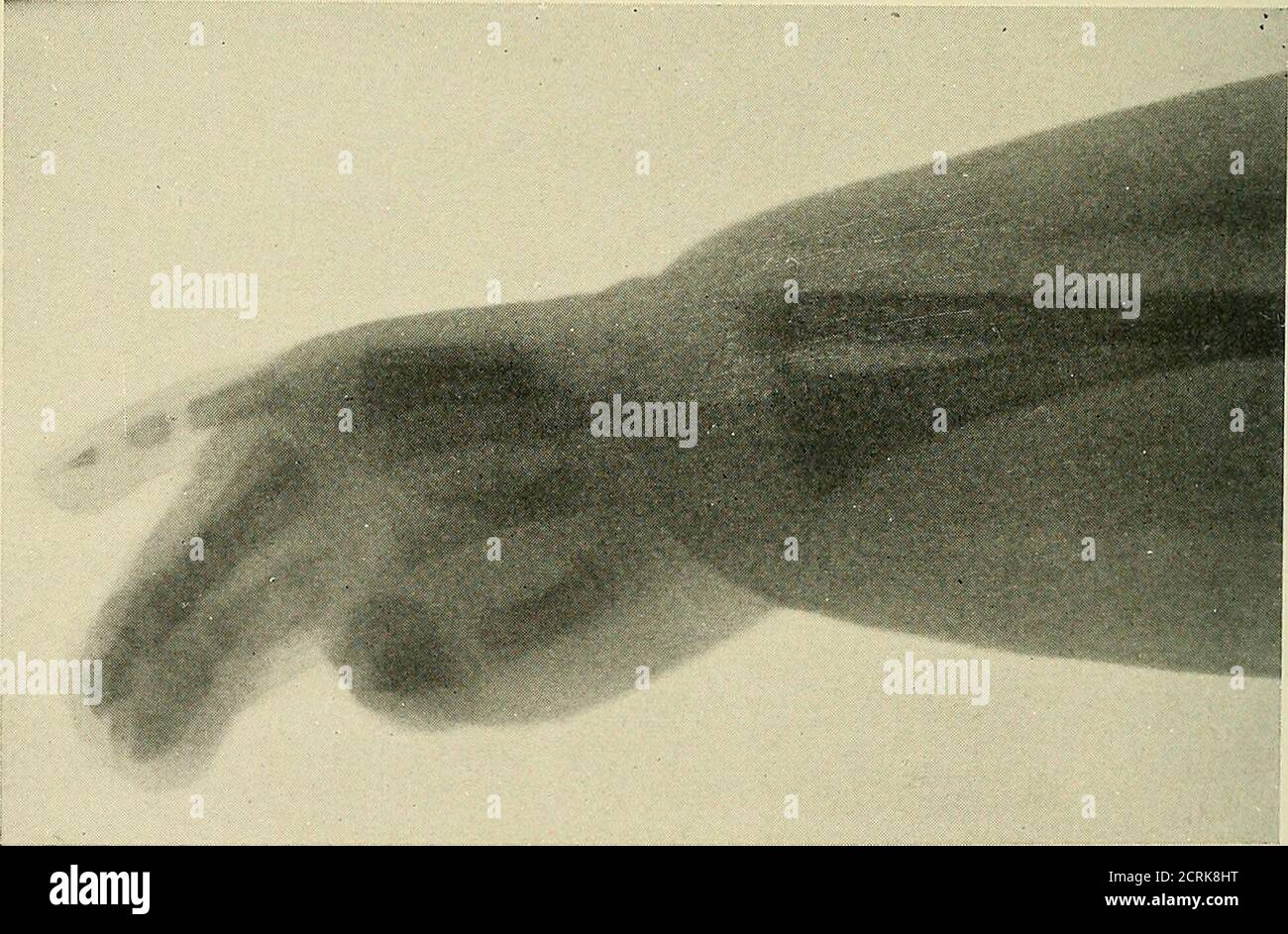 . Röntgen ray diagnosis and therapy . 9.—Old Displaced Fkactukk of the ...