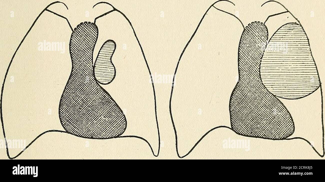. Radio-diagnosis of pleuro-pulmonary affection . leurisy. No ...