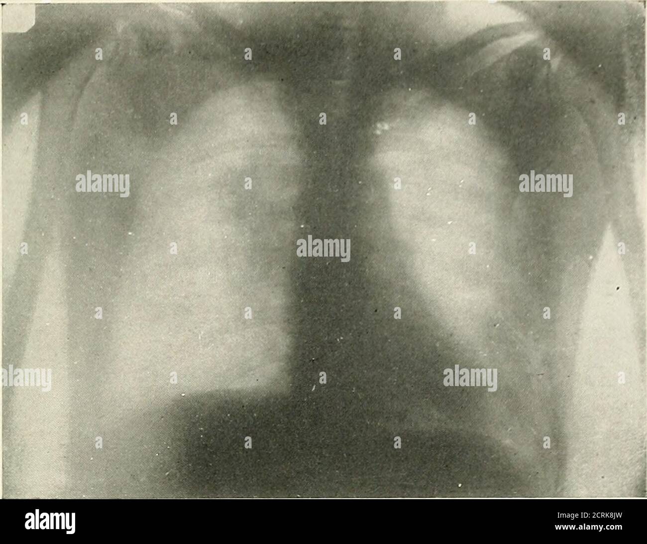 . Radio-diagnosis of pleuro-pulmonary affection . he fluid effusion, on ...
