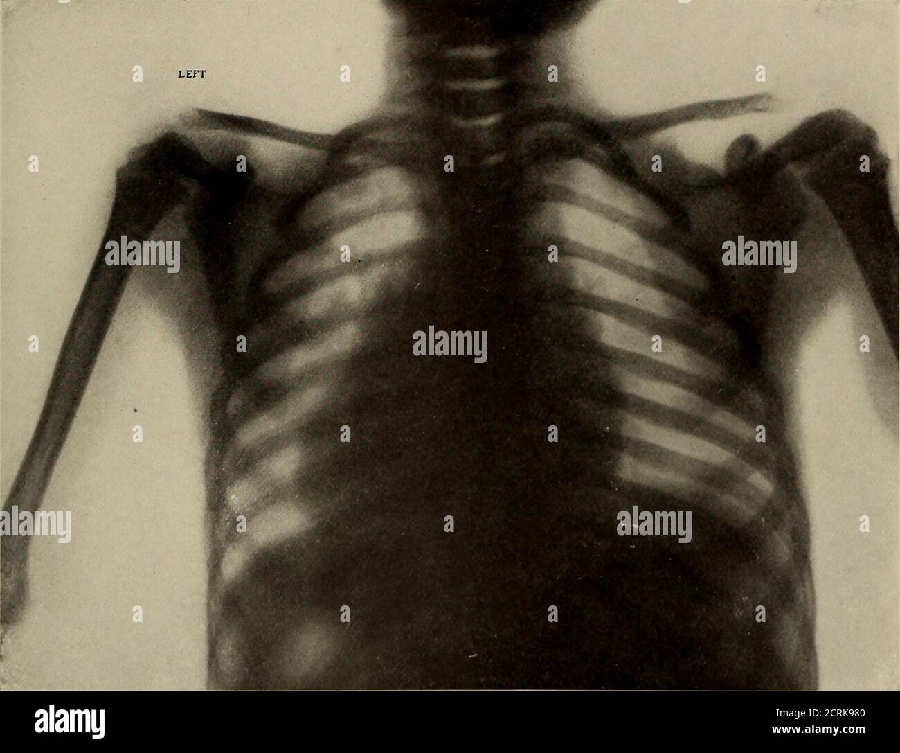. Living anatomy and pathology; . PLATE 72.OBSTETRICAL PARALYSIS OF THE ...