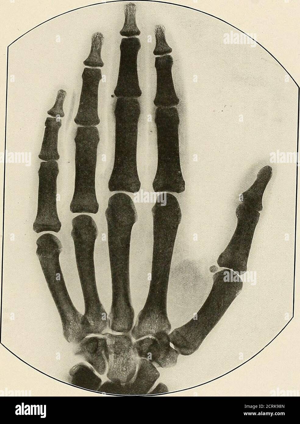 . A radiographic atlas of the pathologic changes of bones and joints ...