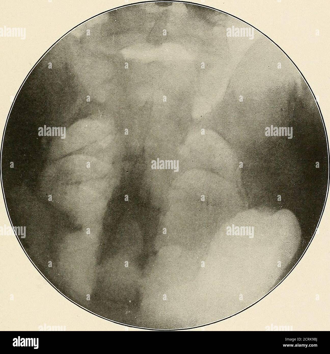 . A radiographic atlas of the pathologic changes of bones and joints ...