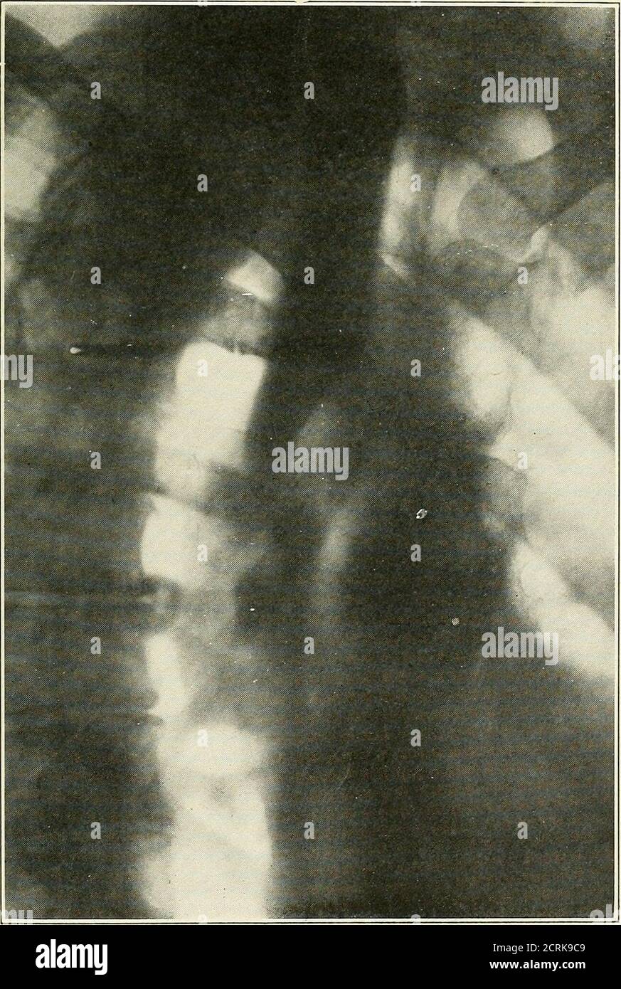 Esophageal Diverticulum High Resolution Stock Photography and Images ...