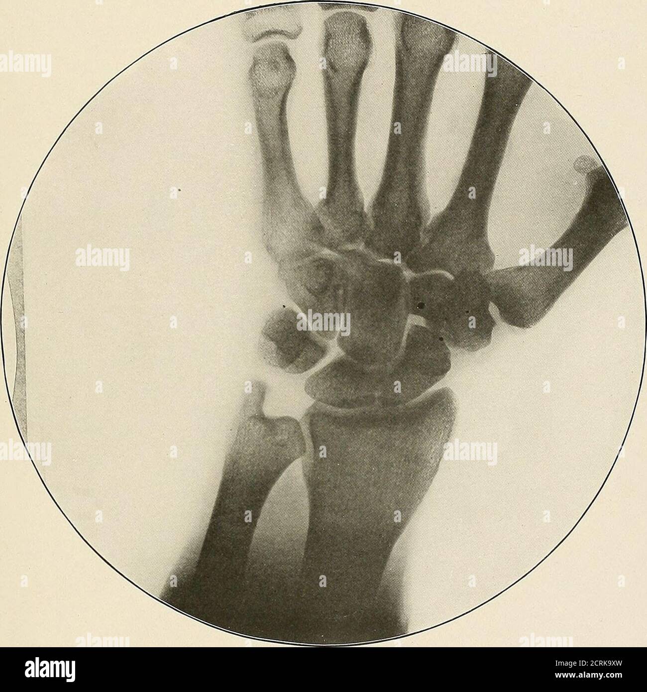 . A radiographic atlas of the pathologic changes of bones and joints ...