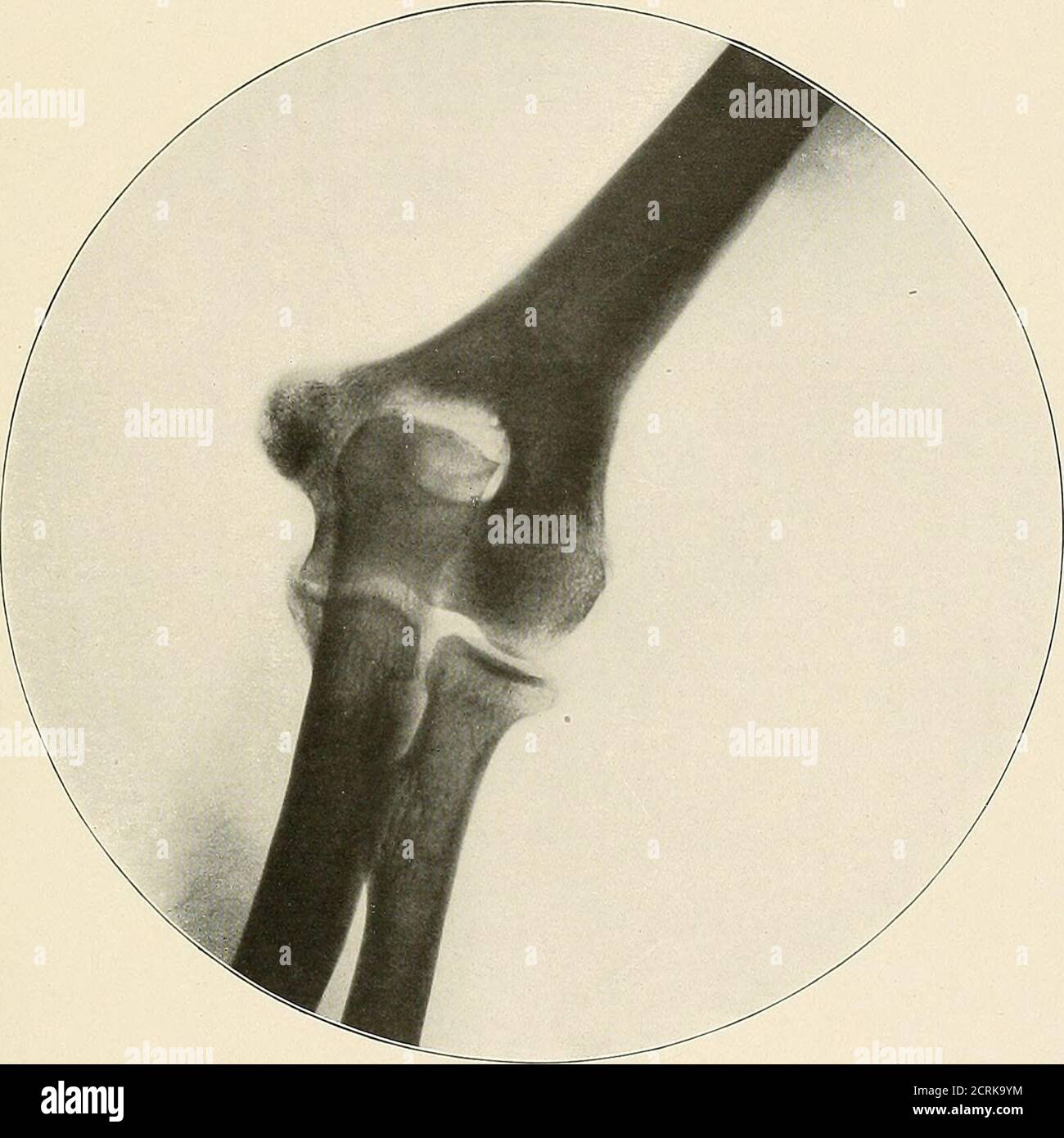 Olecranon fossa hi-res stock photography and images - Alamy