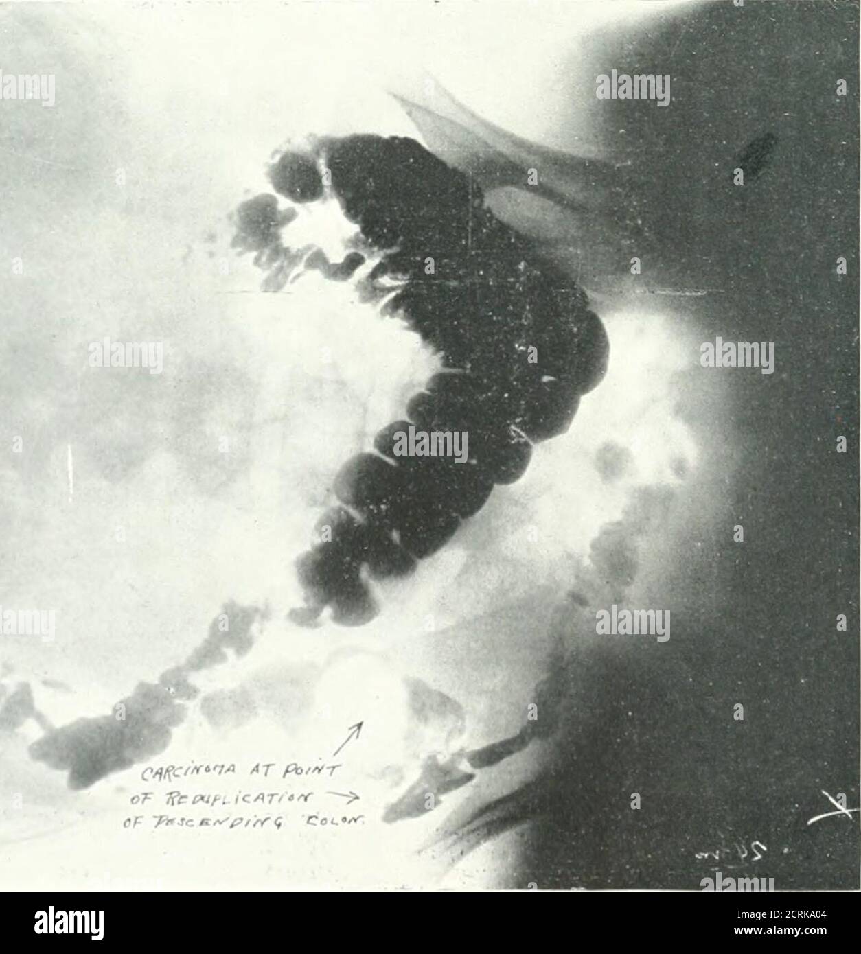 Trendelenburg position hi-res stock photography and images - Alamy