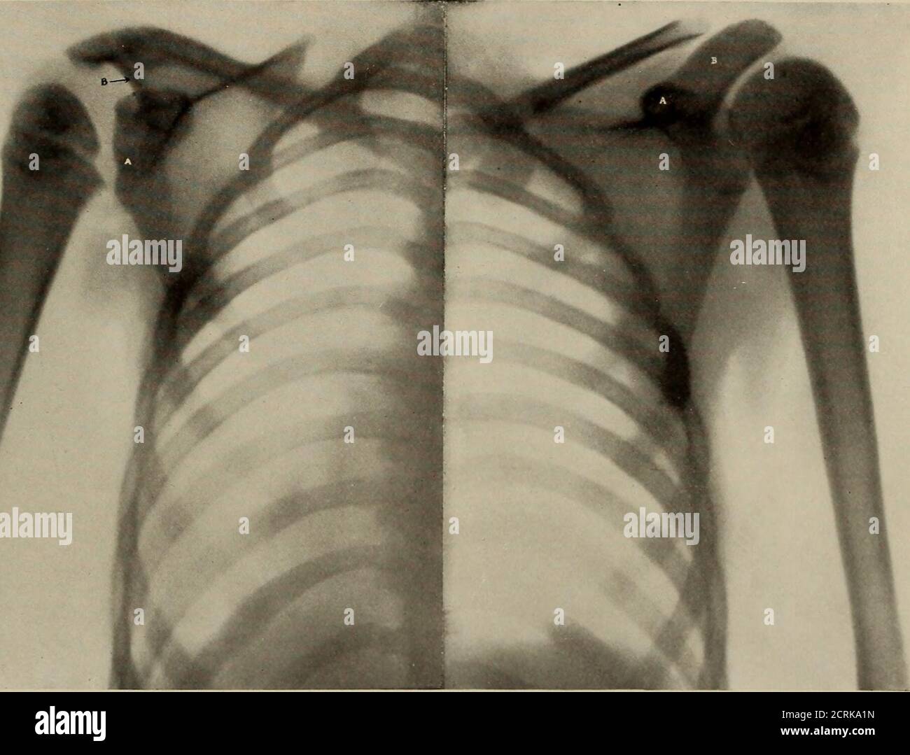 . Living anatomy and pathology; . PLATE 71.OBSTETRICAL PARALYSIS OF THE ...