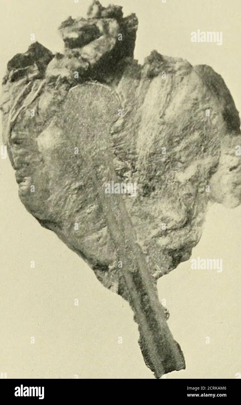 Soft tissue sarcoma hi-res stock photography and images - Alamy