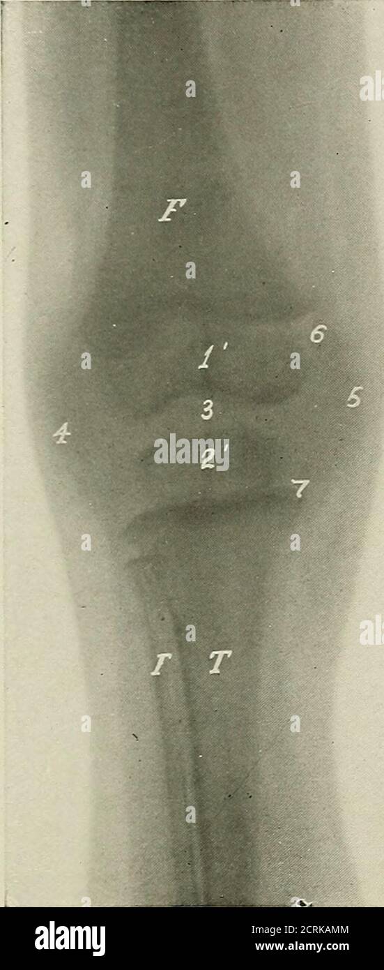 Periarticular tissue hi-res stock photography and images - Alamy