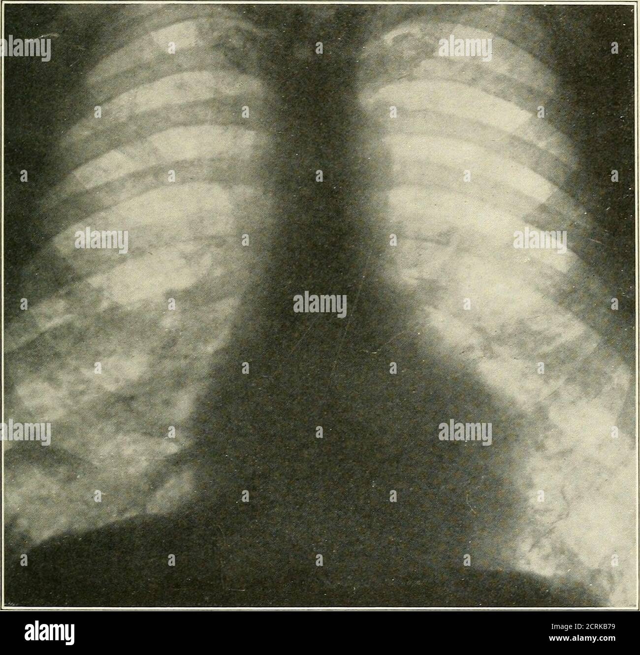 Lung abscess hi-res stock photography and images - Alamy