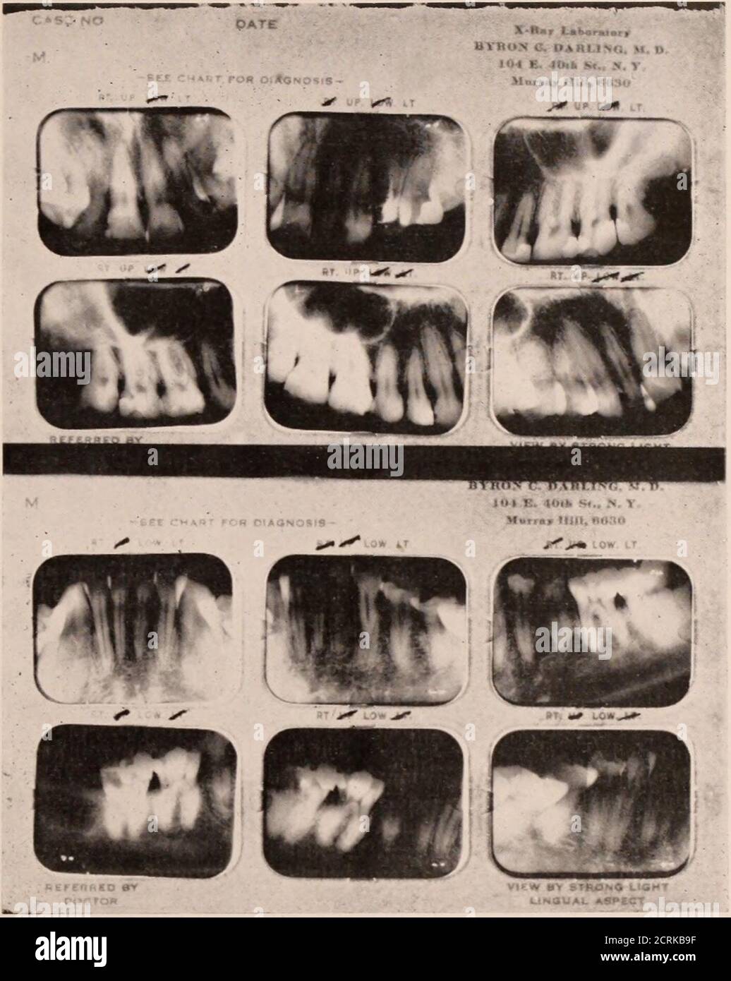 Periapical Abscess Histology