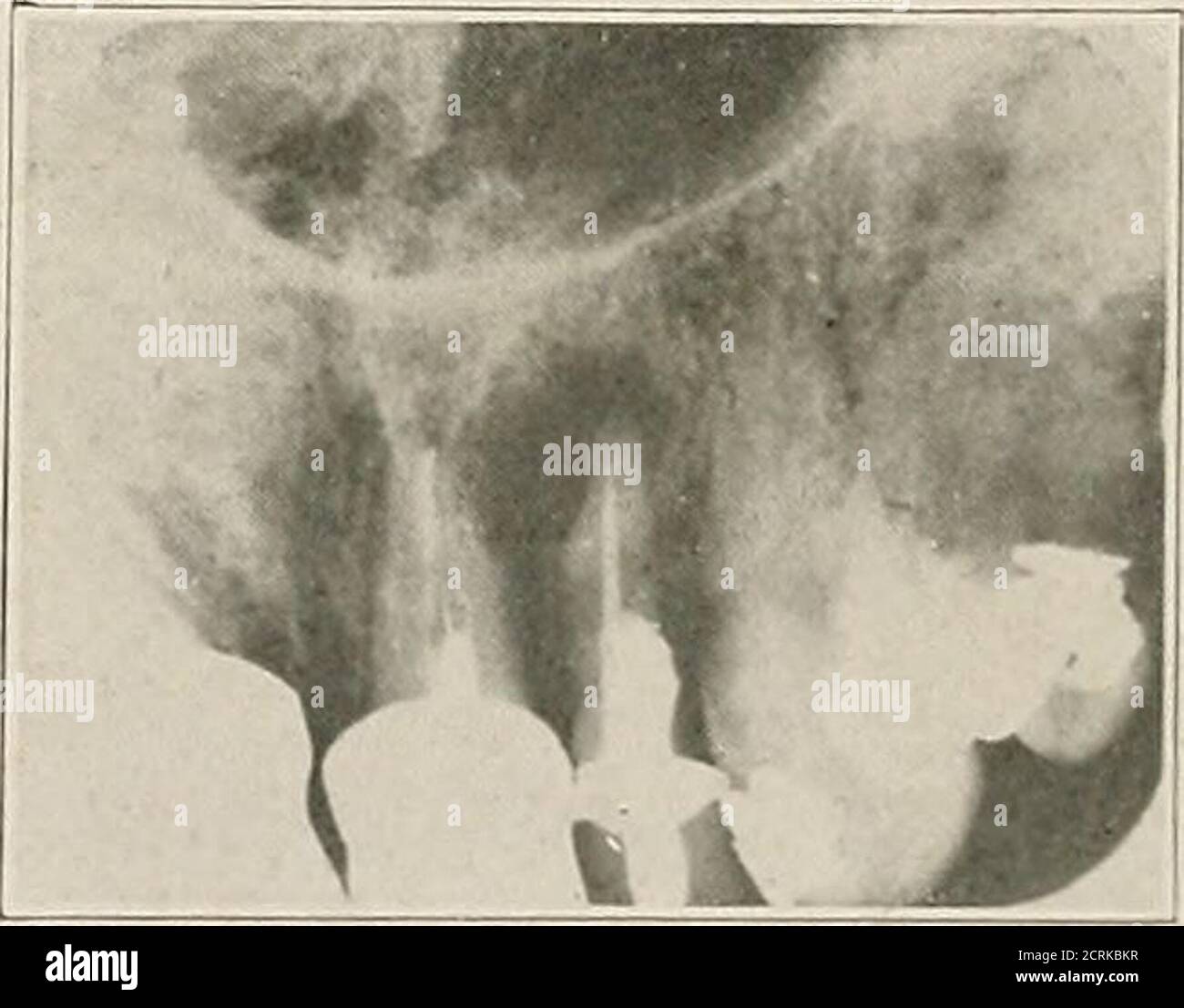 . Interpretation of dental and maxillary roentgenograms . Fig. 22-R ...