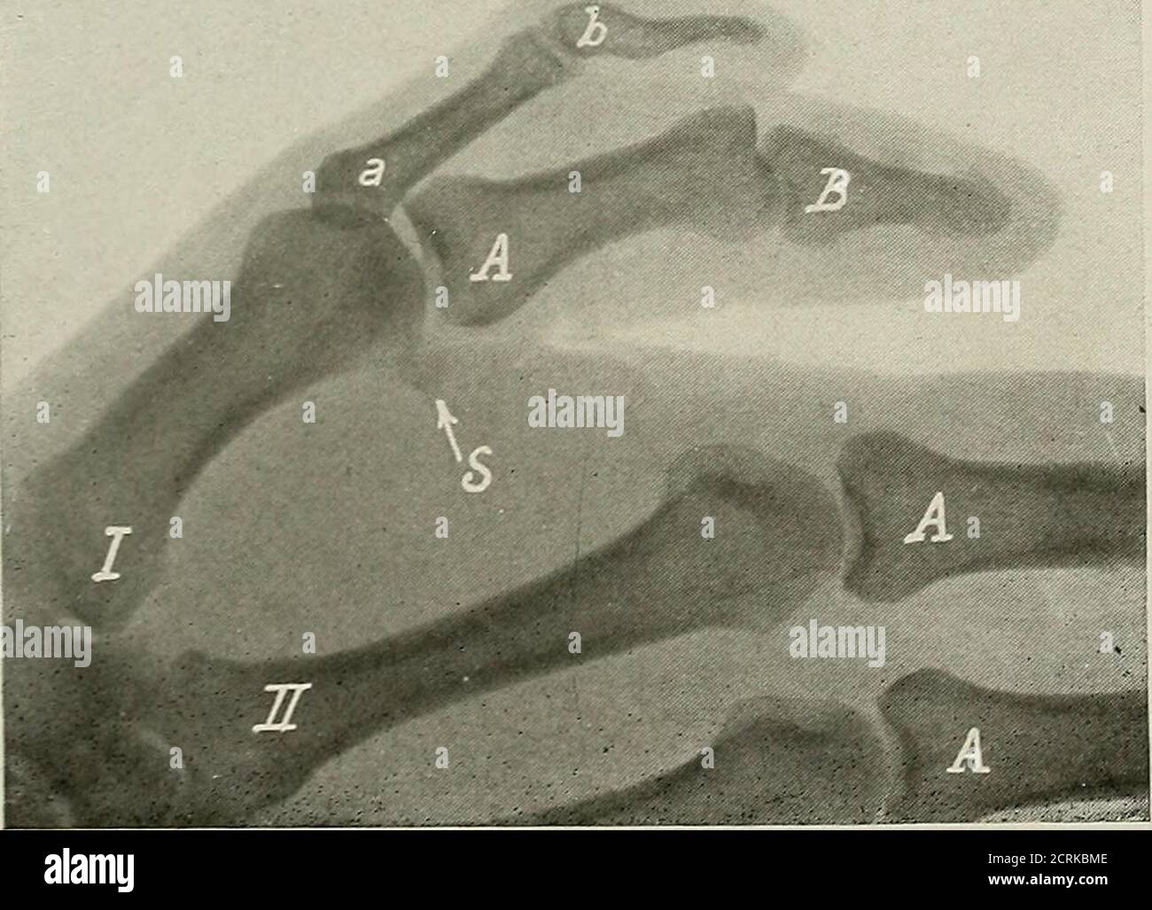 Necrosis foot hi-res stock photography and images - Alamy