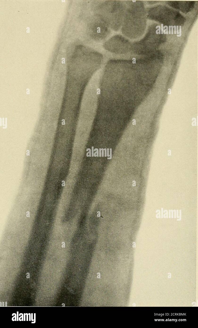 . Röntgen ray diagnosis and therapy . Fro. 152.—Fracture of Radial ...