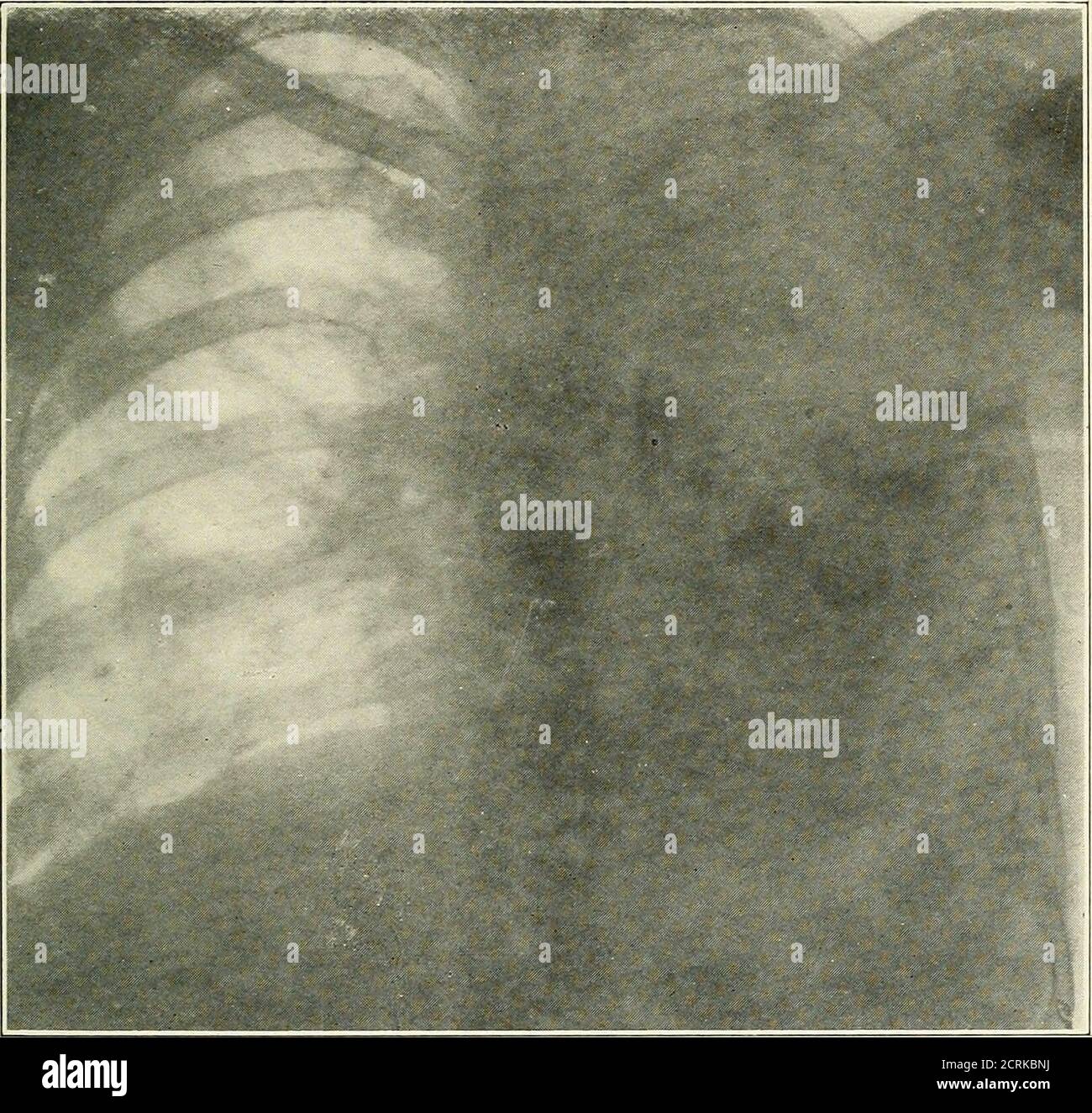 Syphilis Lungs High Resolution Stock Photography and Images - Alamy