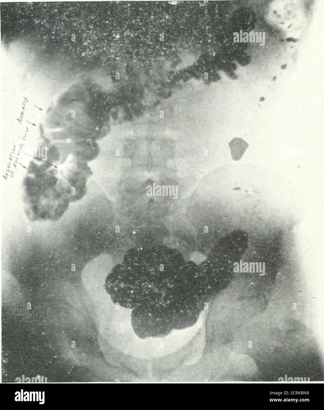 . Archives of physical medicine and rehabilitation . Pig-. 13. Pelvic ...